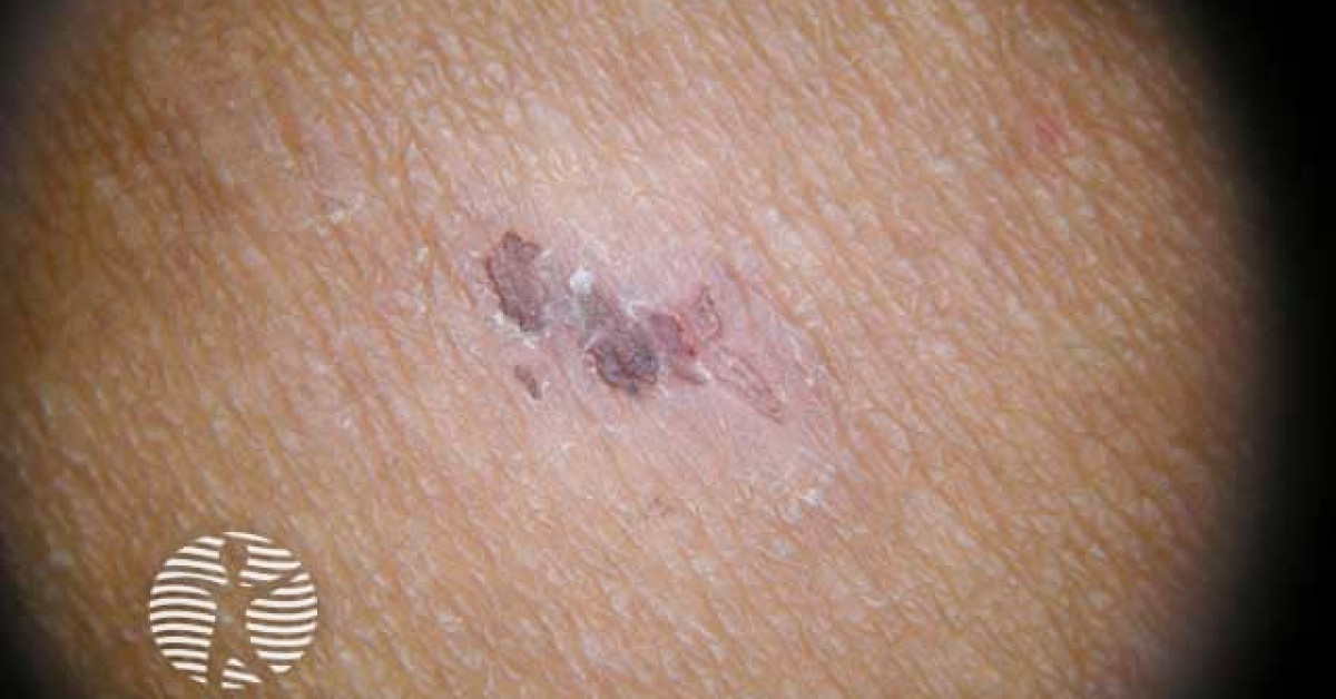 Pityriasis lichenoides image