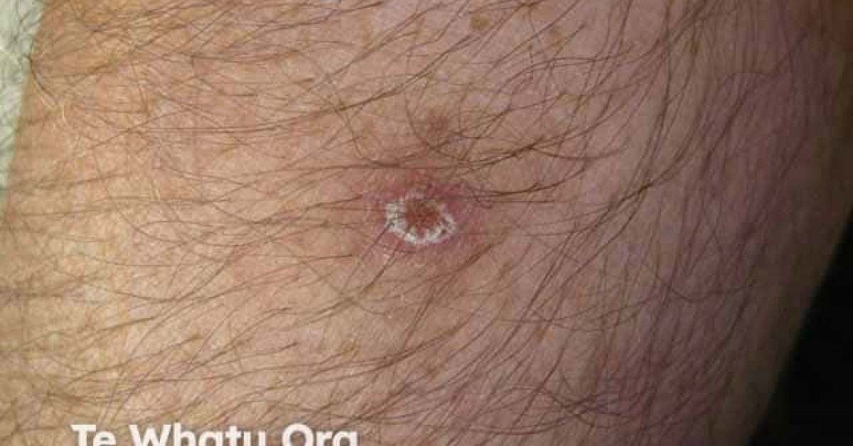 Pityriasis Lichenoides Image