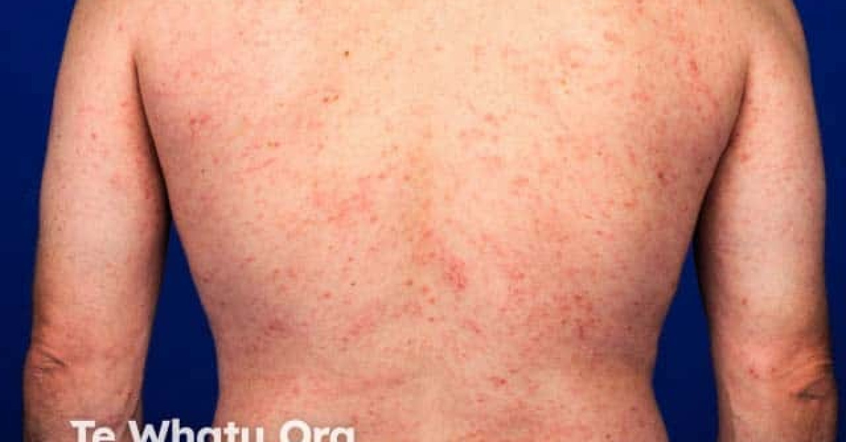 Pityriasis lichenoides image