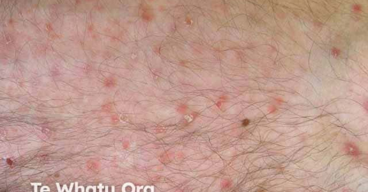 Pityriasis lichenoides image