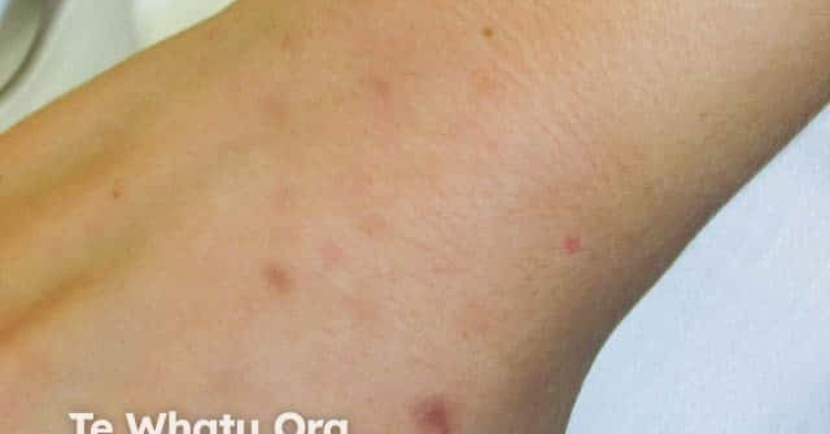 Pityriasis lichenoides image