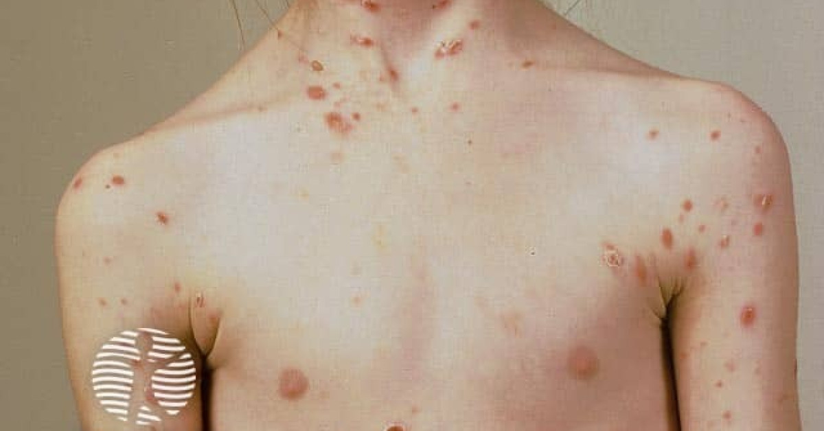 Pityriasis lichenoides image