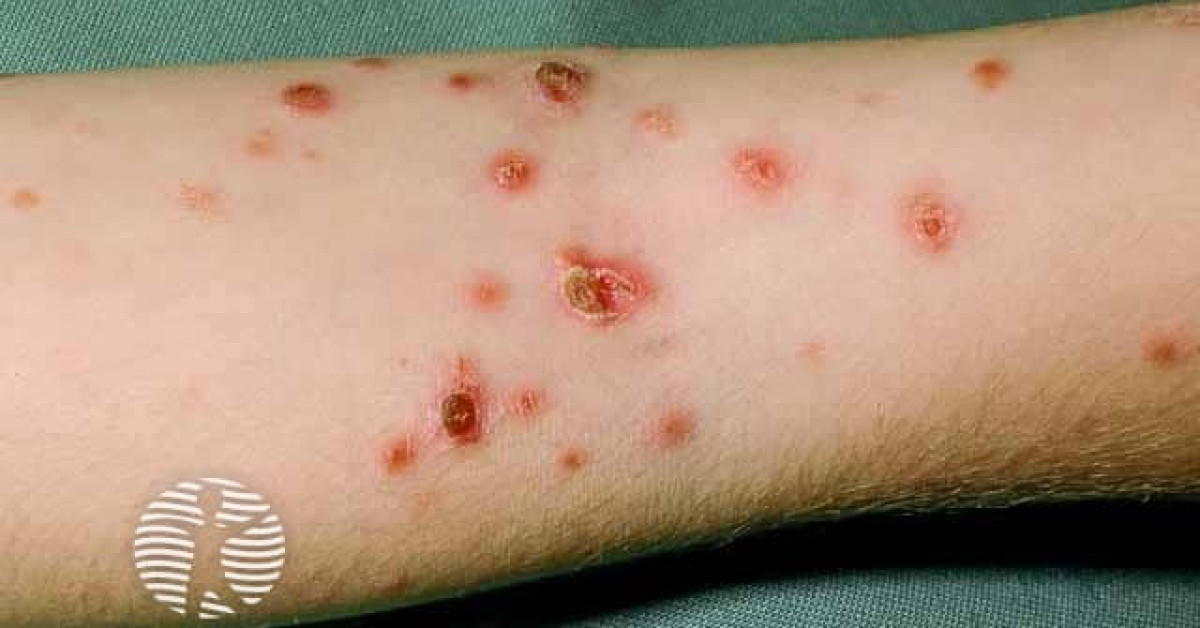 Pityriasis lichenoides image