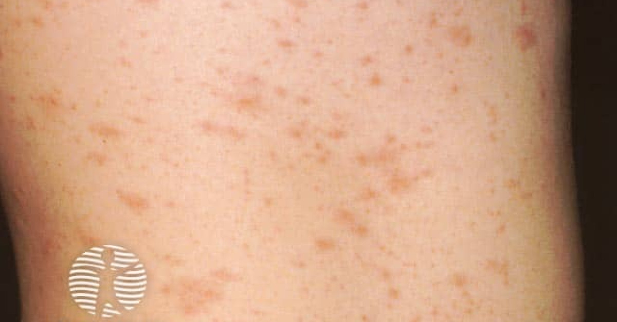 Pityriasis rosea image