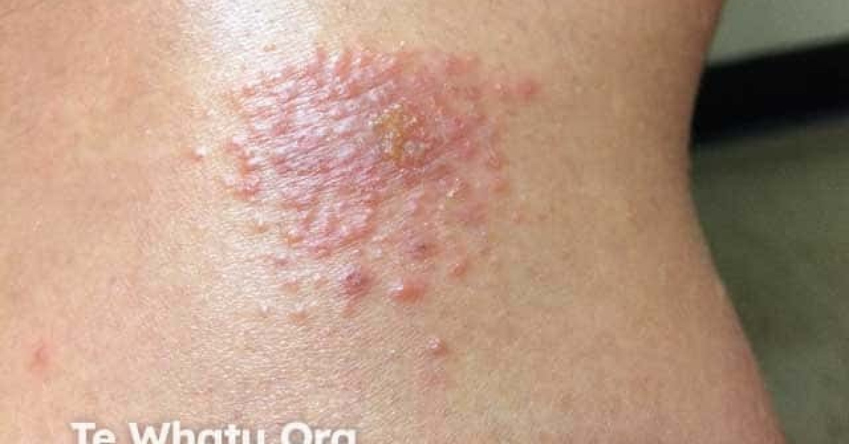 Pityriasis rosea image