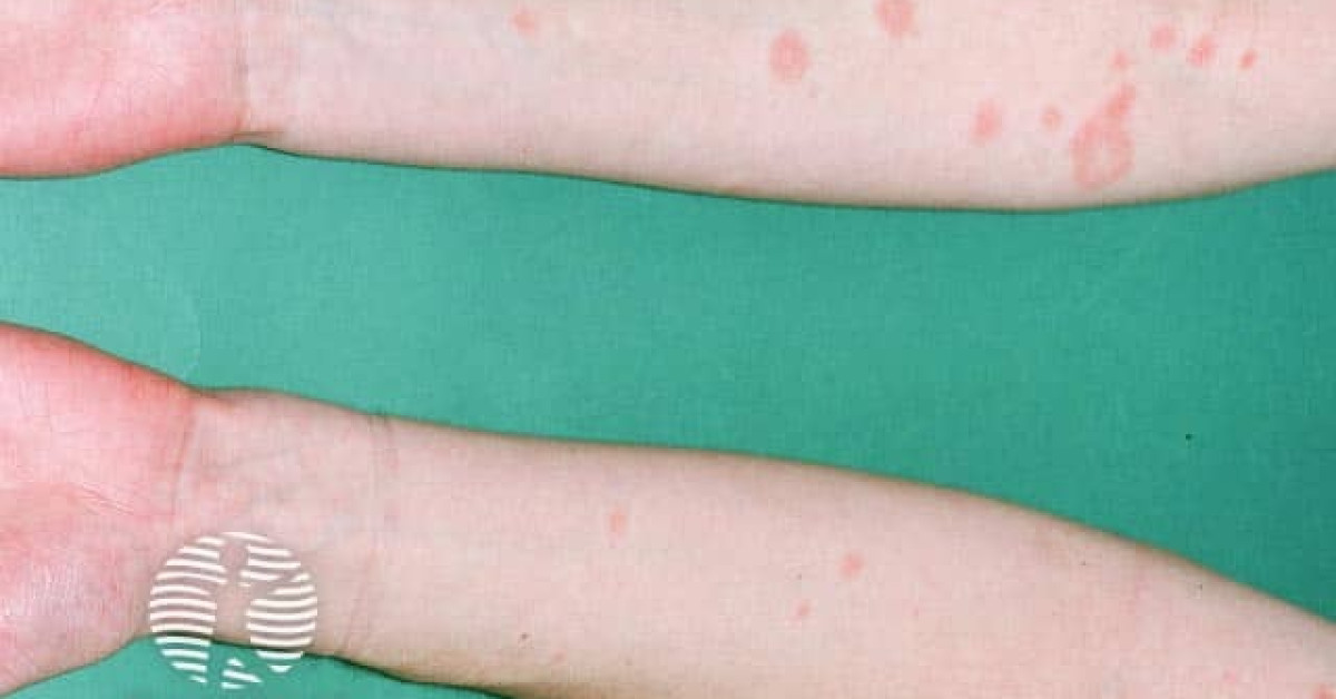 Pityriasis rosea image
