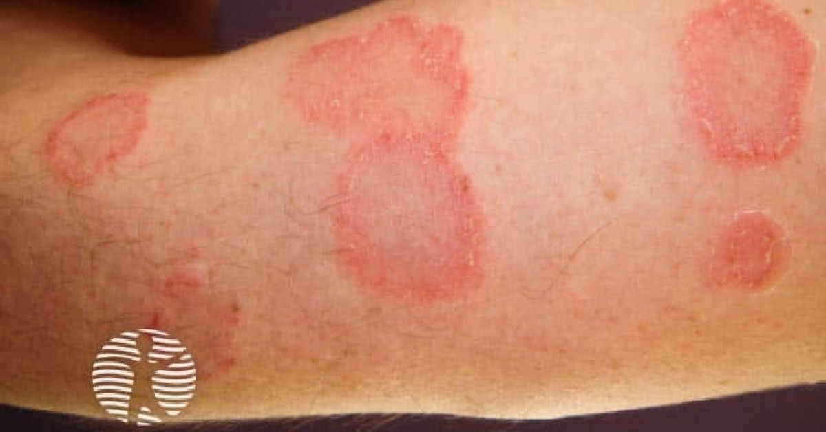Pityriasis rosea image