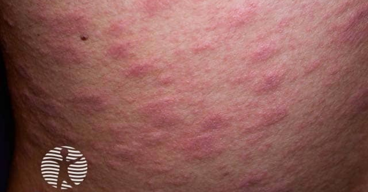 Pityriasis rosea image