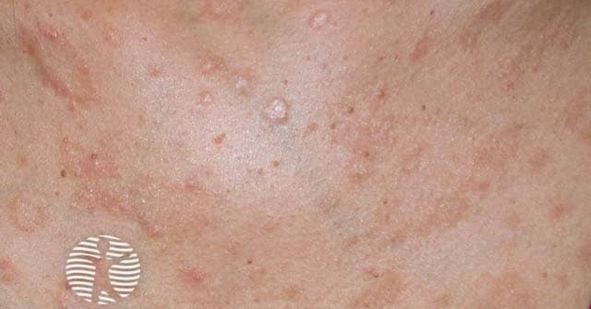 Pityriasis Rosea Face White Spots On Skin: Pictures, Causes, Treatment
