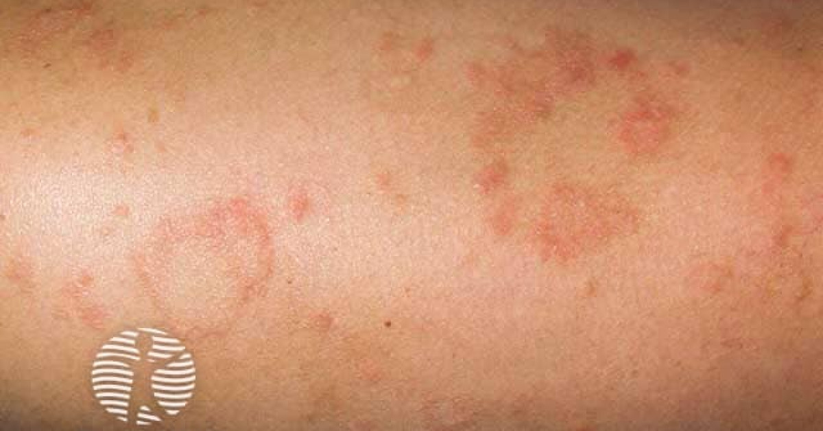 Pityriasis rosea image