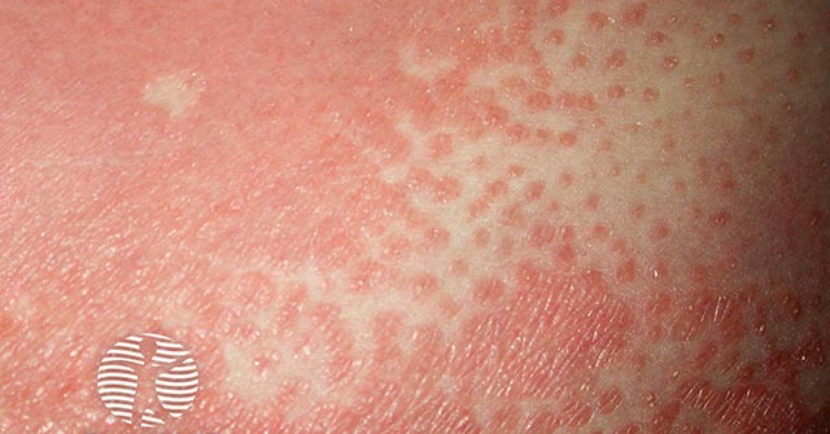 Pityriasis rubra pilaris image