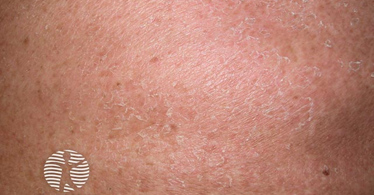 Pityriasis rubra pilaris image