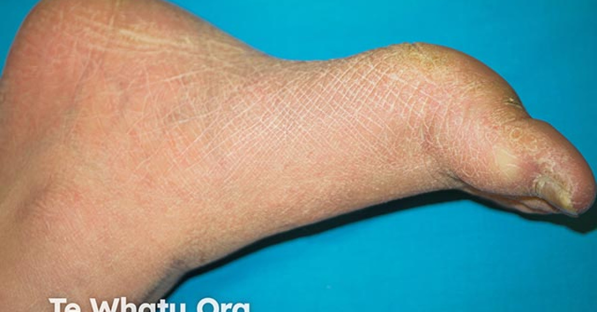Pityriasis rubra pilaris image
