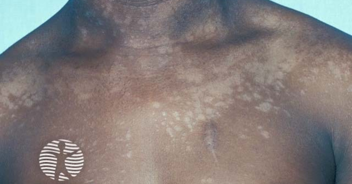 Pityriasis versicolour image