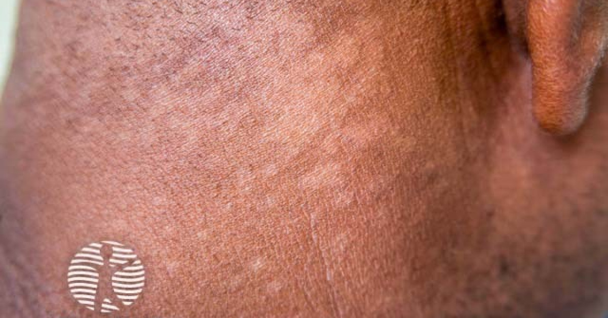 Pityriasis versicolour image