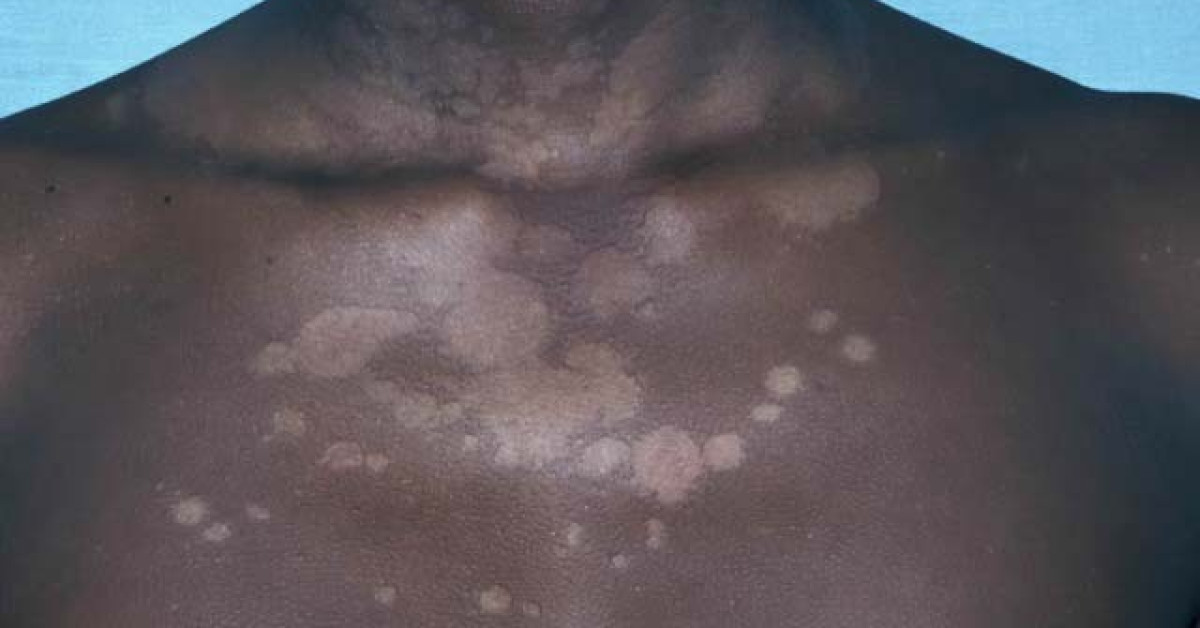 Pityriasis versicolour image