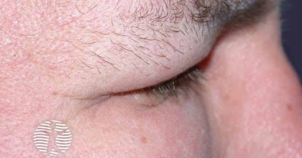 DermNet® - Plant dermatitis image