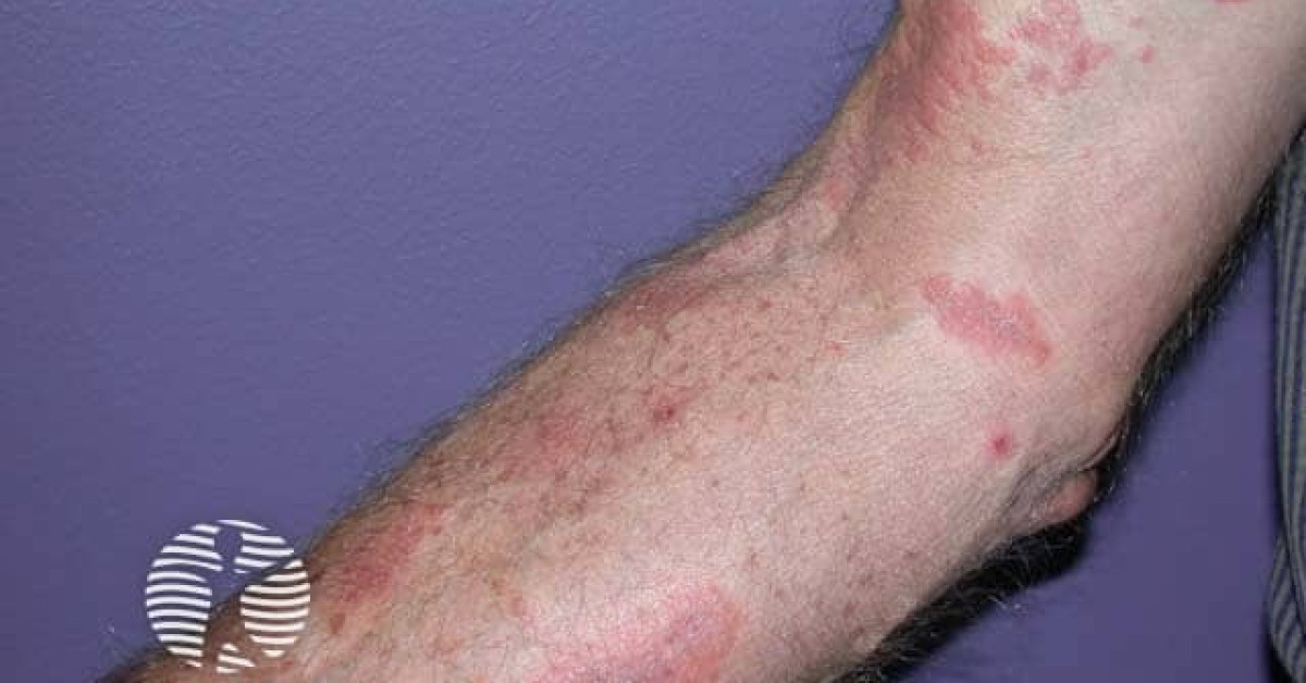 DermNet® - Plant dermatitis image