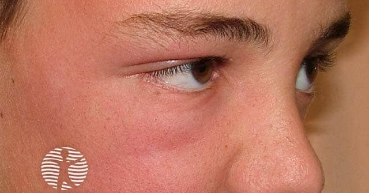 DermNet® - Plant dermatitis image