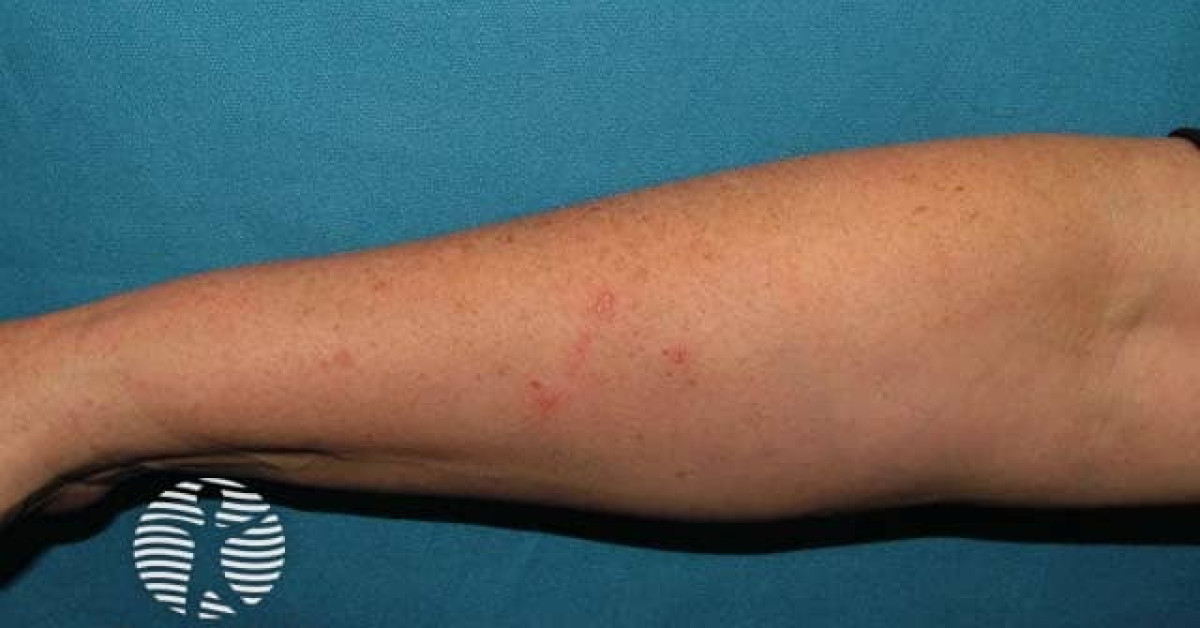 Plant dermatitis image