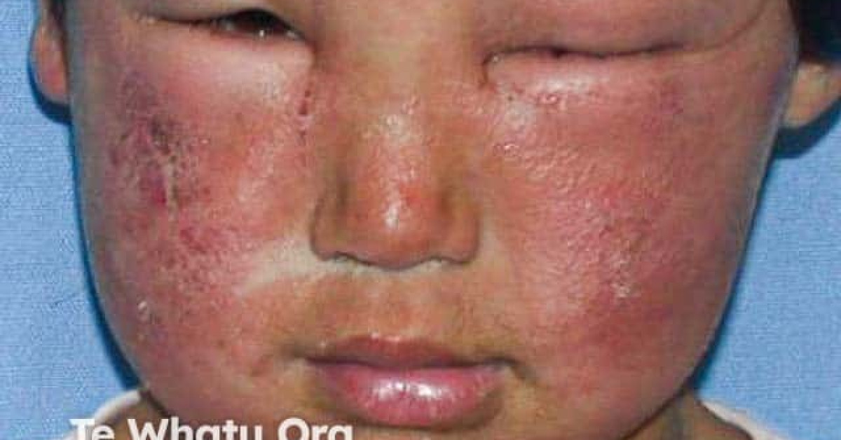 Plant dermatitis image