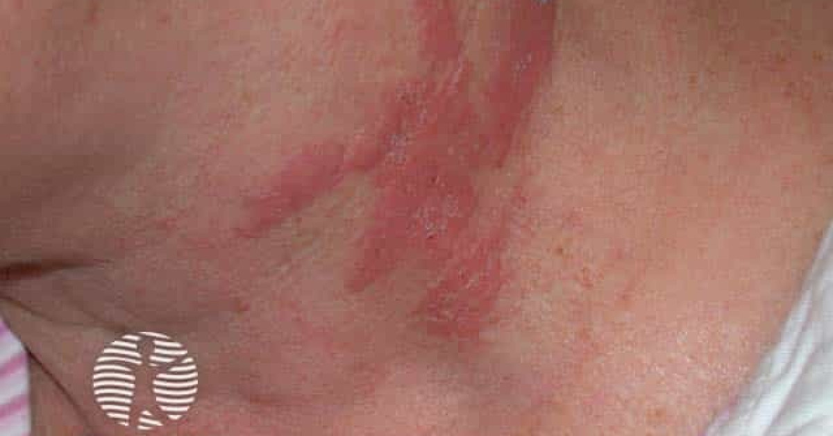 Plant dermatitis image