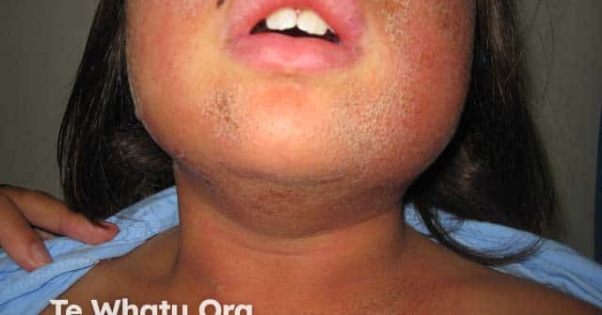 Plant dermatitis image