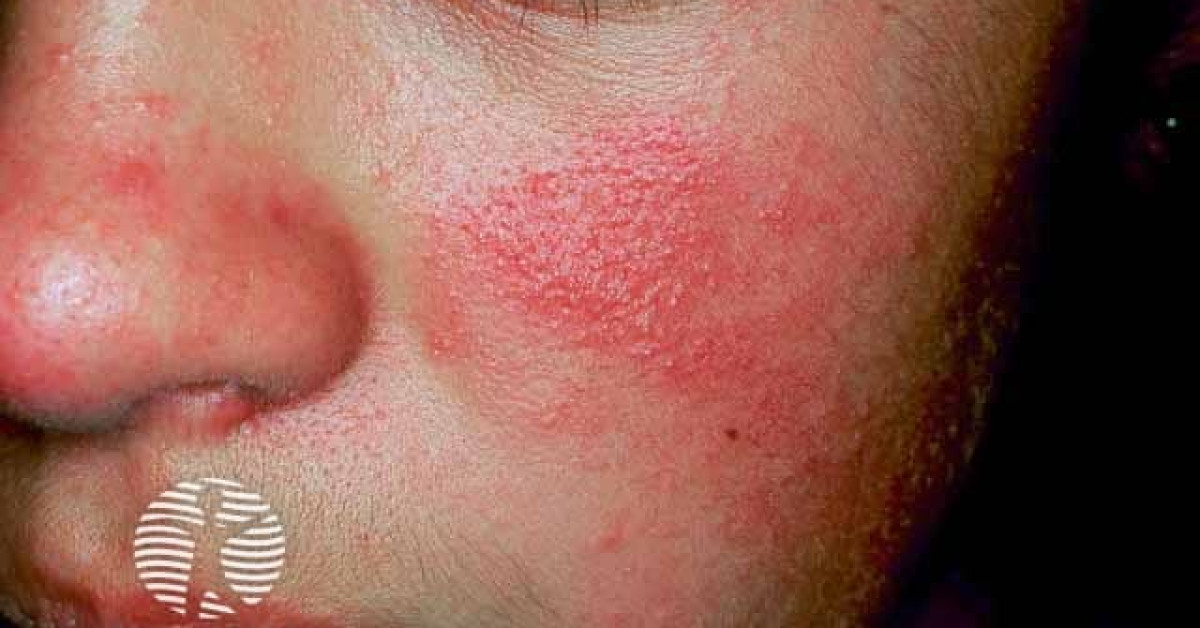 Plant dermatitis image