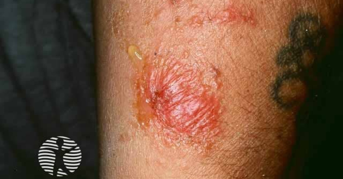 Plant dermatitis image