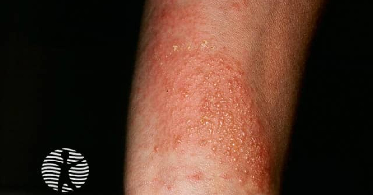 Plant dermatitis image