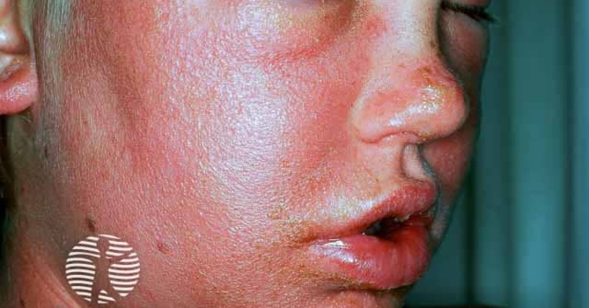 Plant dermatitis image