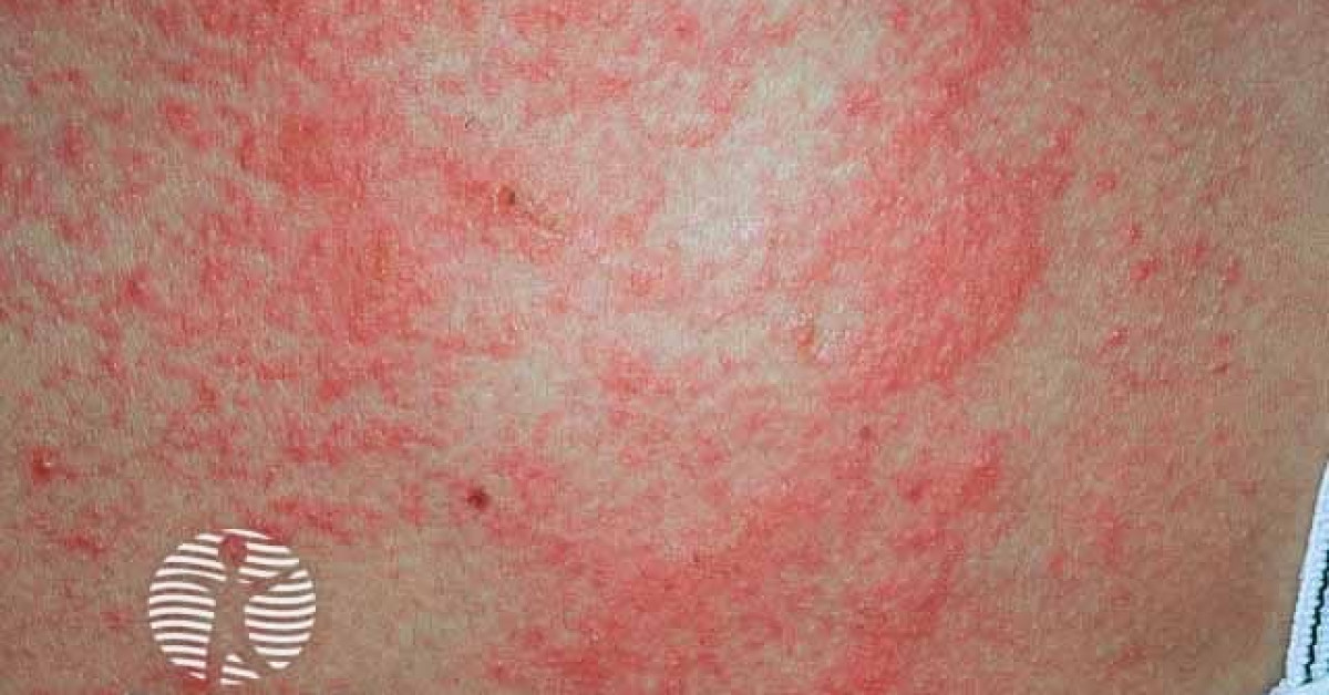 Plant dermatitis image