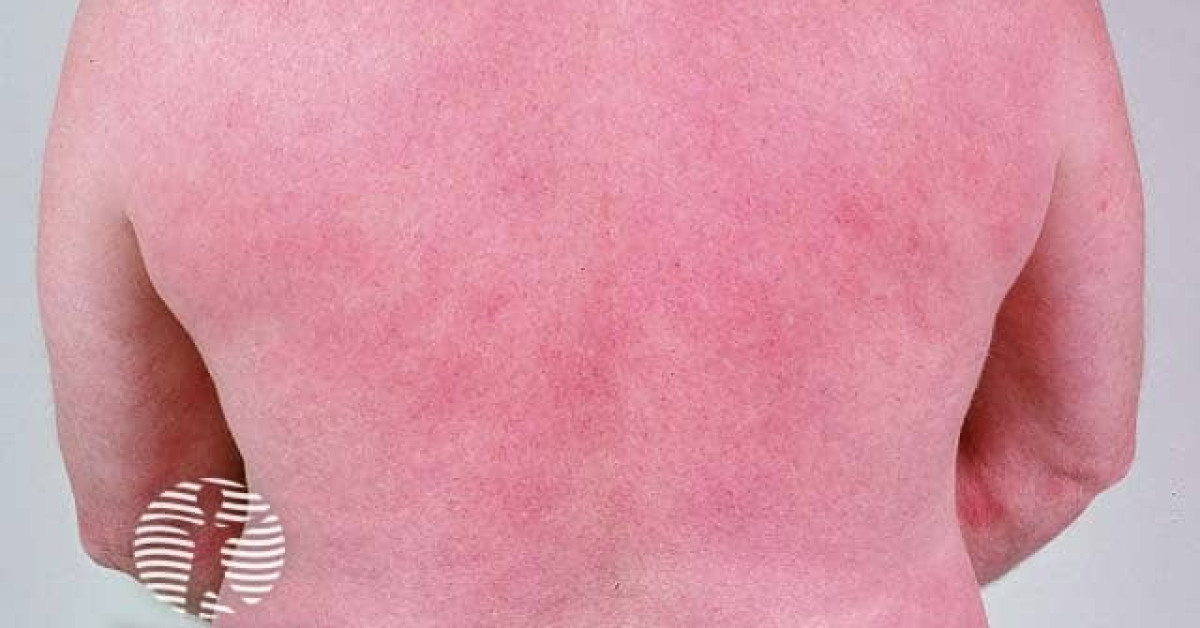 Plant dermatitis image