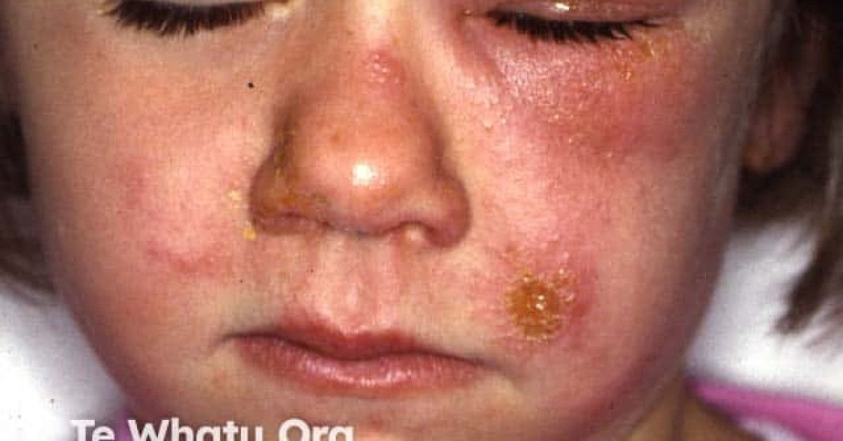 Plant dermatitis image