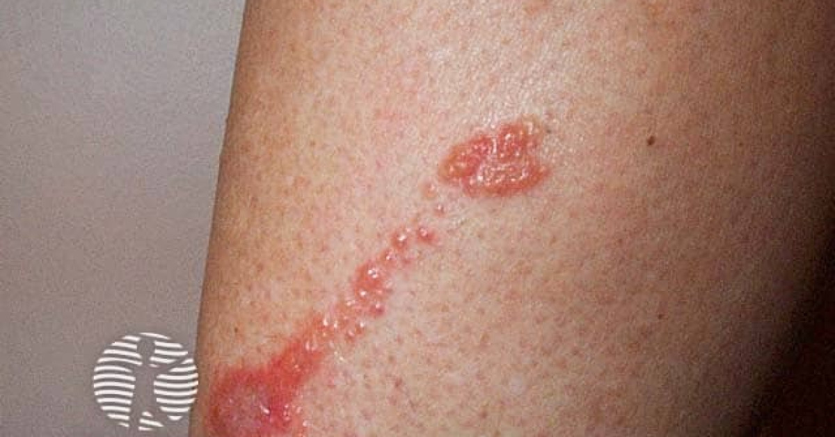 Plant dermatitis image
