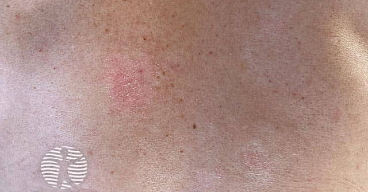 Plaque psoriasis image