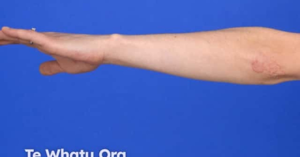 Plaque psoriasis image