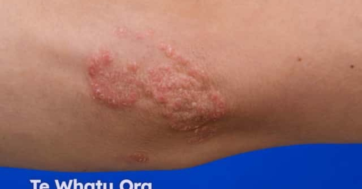Plaque psoriasis image
