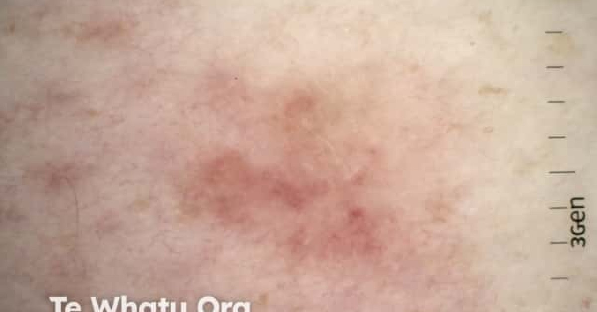 Plaque psoriasis image