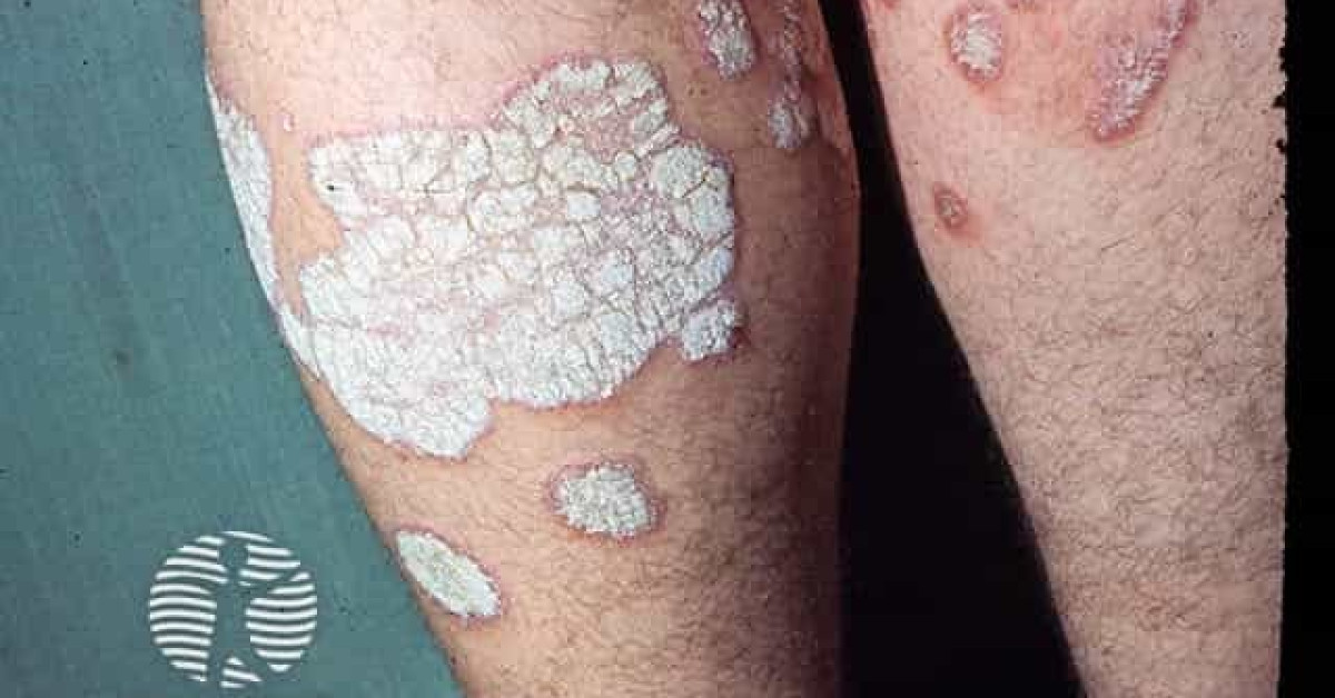 Plaque Psoriasis Image