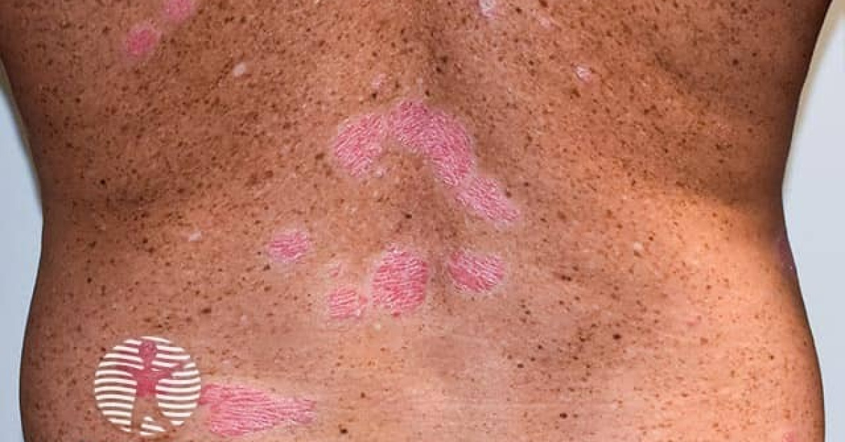 Plaque psoriasis image