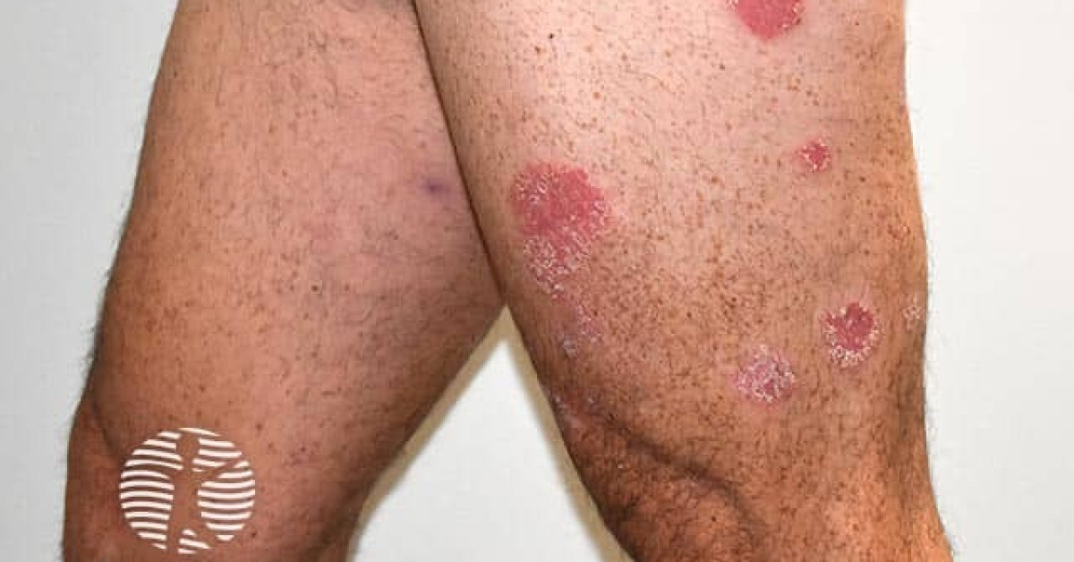 Plaque psoriasis image
