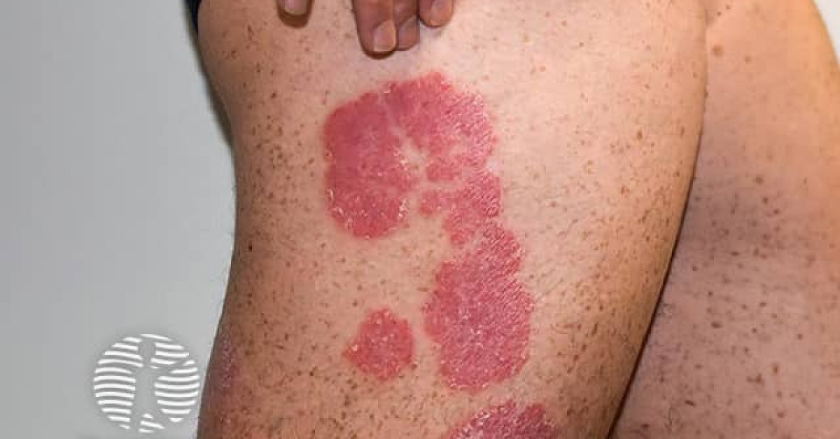 Plaque psoriasis image