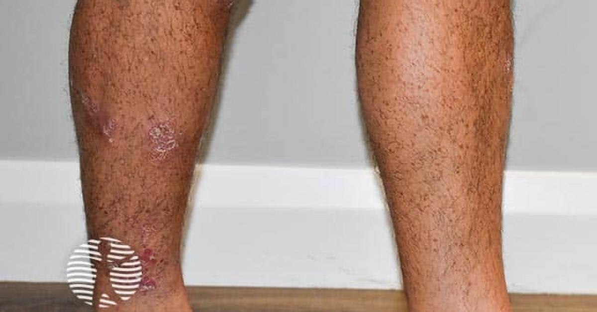 Plaque psoriasis image