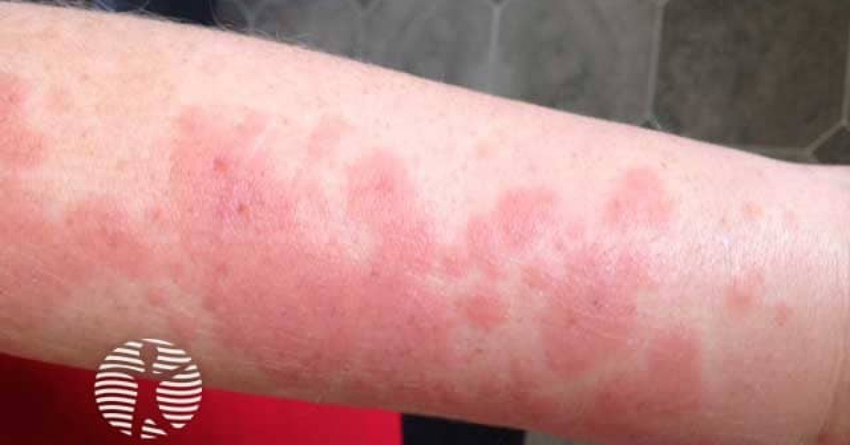 Polymorphic light eruption image