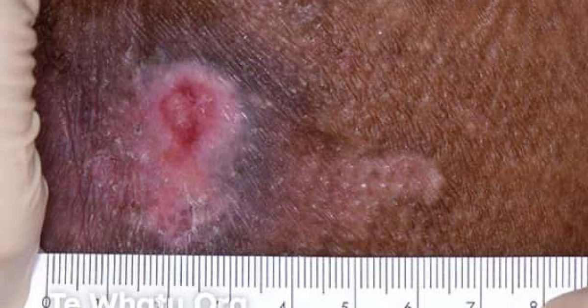 Pressure ulcer image