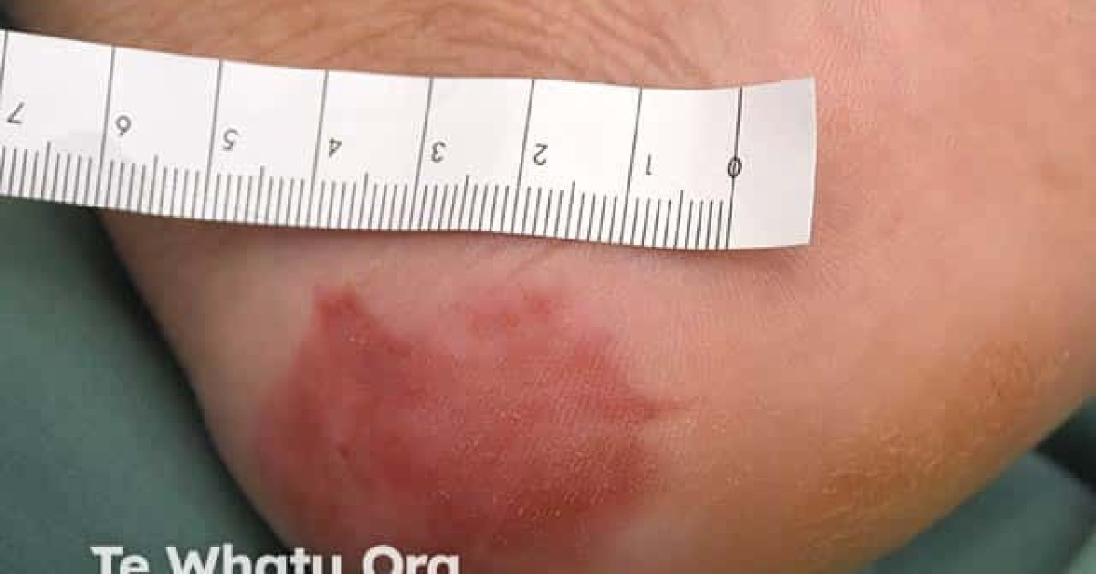 Pressure ulcer image