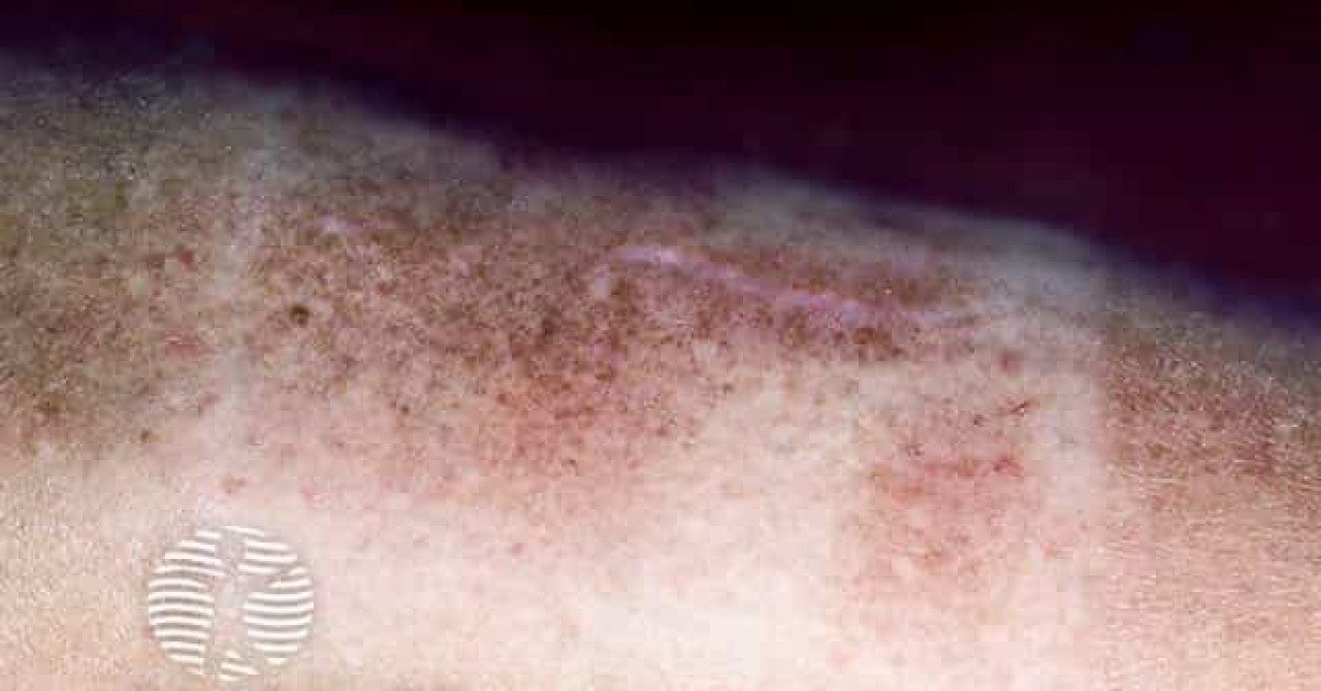 Pretibial myxoedema image