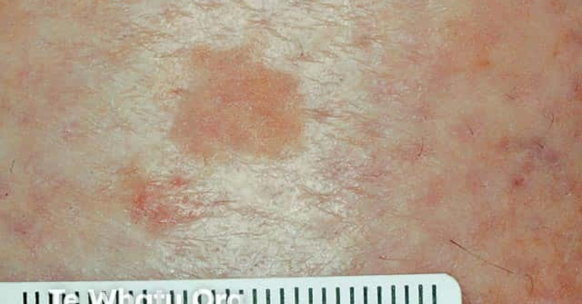 Pretibial myxoedema image