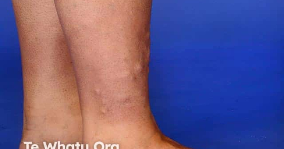 Pretibial myxoedema image